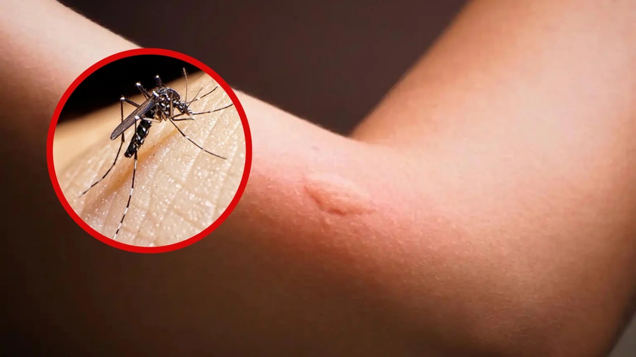Cuál es la diferencia de una picadura del mosquito del dengue con la de ...